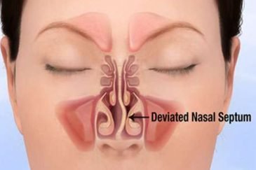 Deviated Nasal Septum - Brain and ENT Clinic - Dr Lalit Mahajan In ...